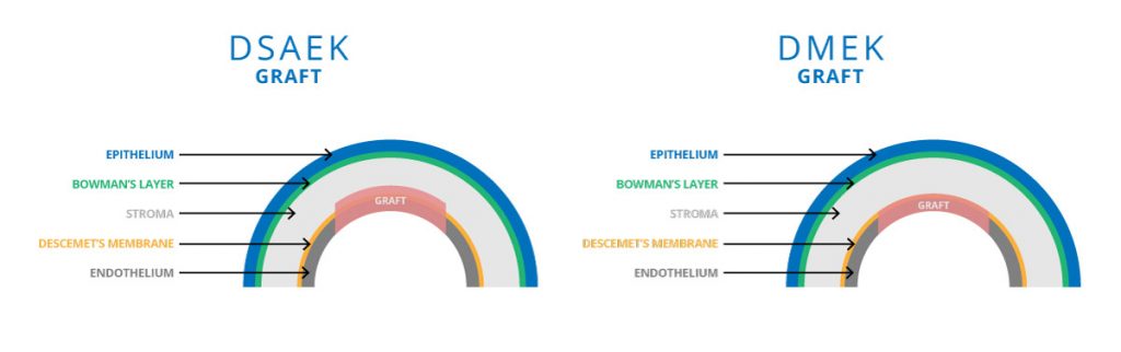 Types of Transplants